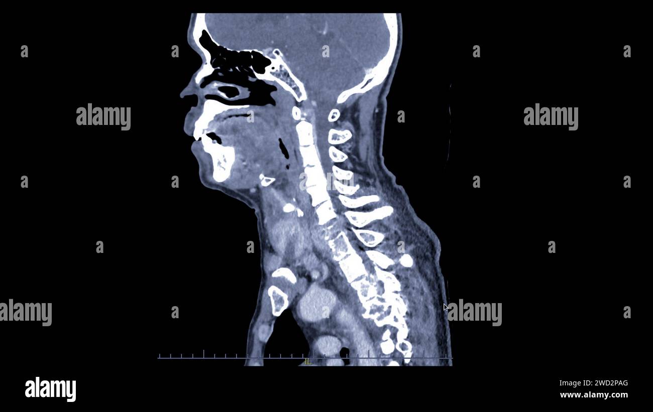 A CT scan of the neck sagittal view for diagnostic technique is ...