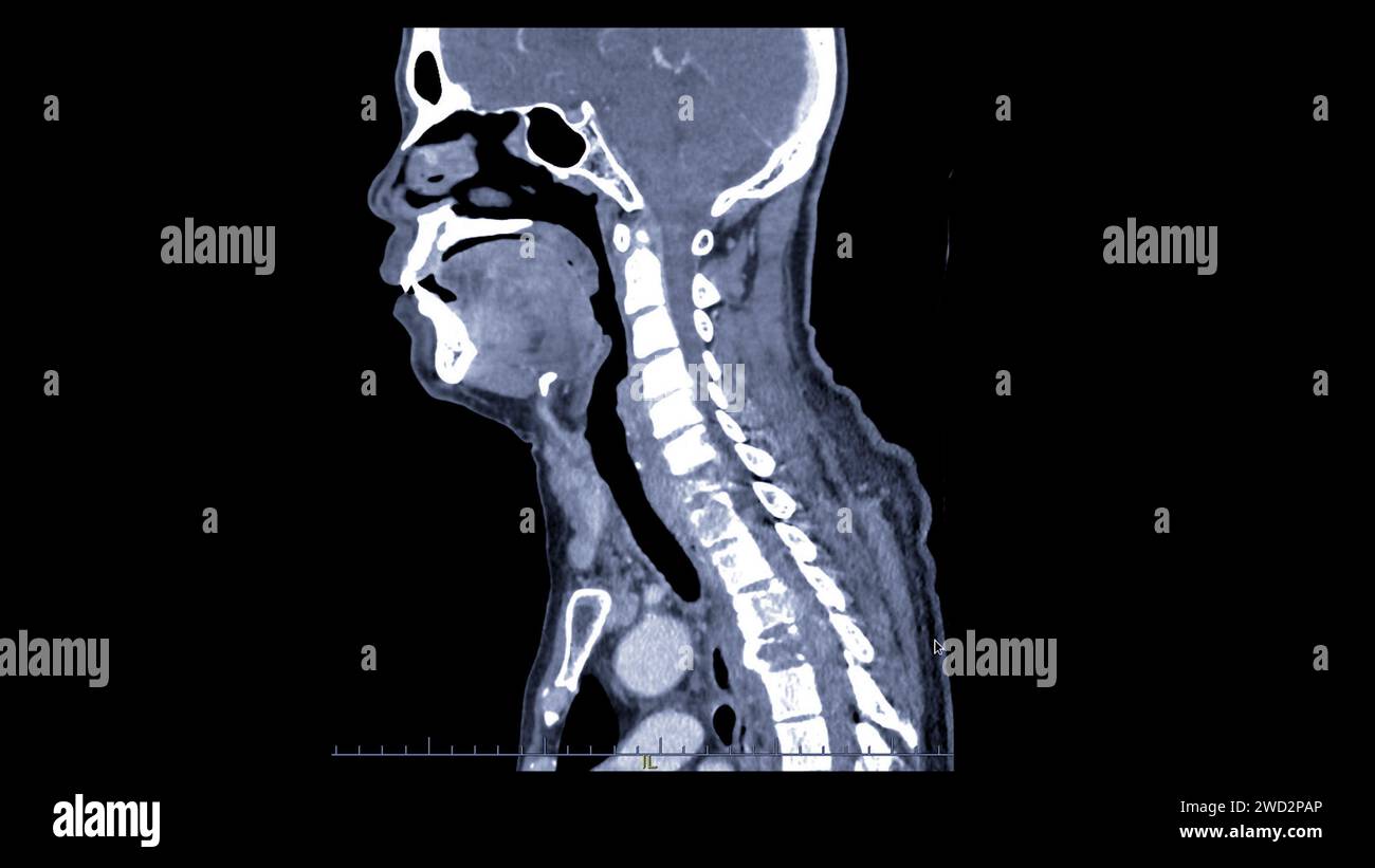 A CT scan of the neck sagittal view for diagnostic technique is ...
