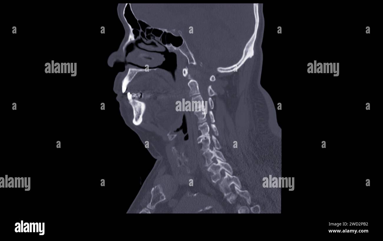 A CT scan of the neck sagittal view for diagnostic technique is ...