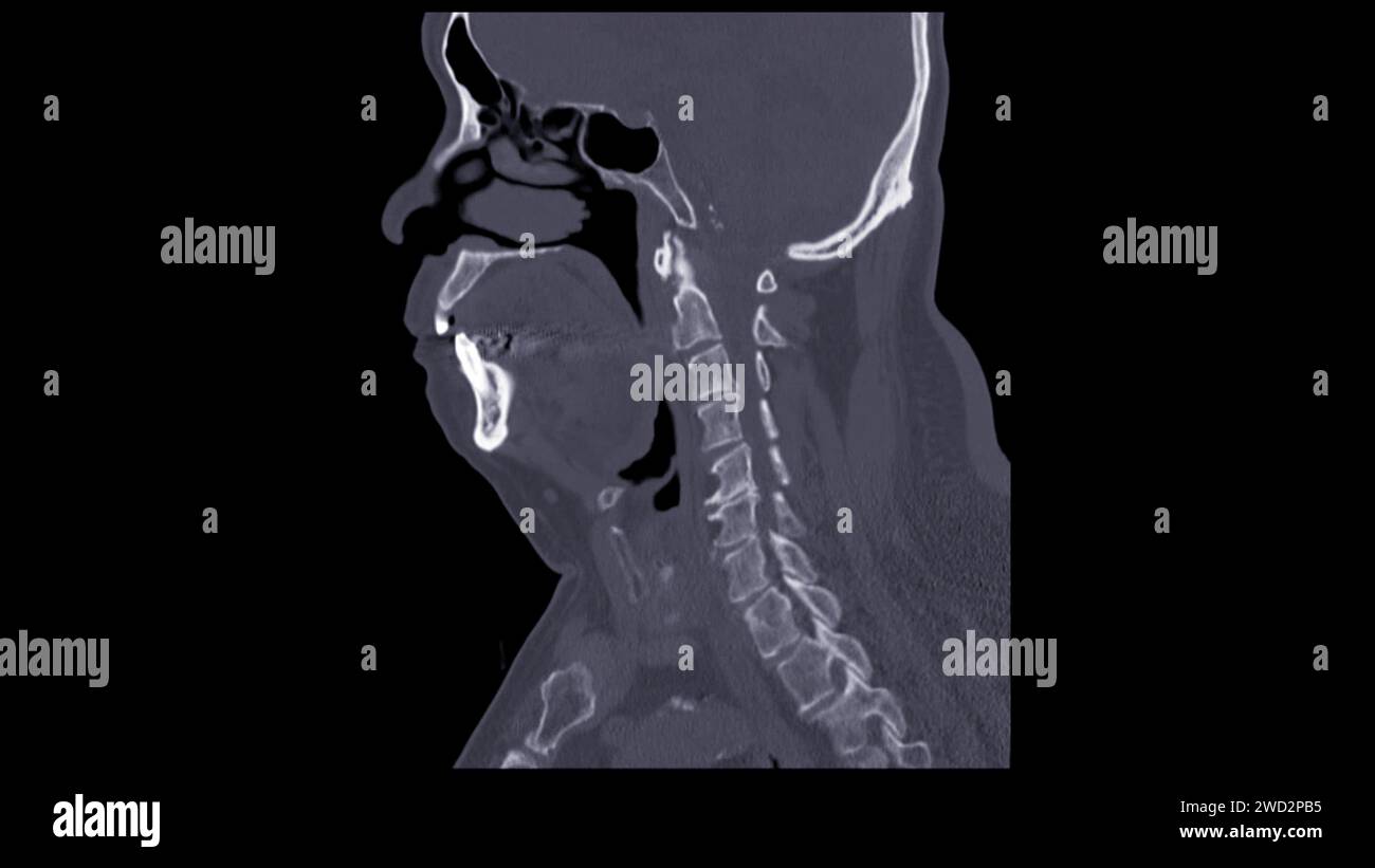 A CT scan of the neck sagittal view for diagnostic technique is ...