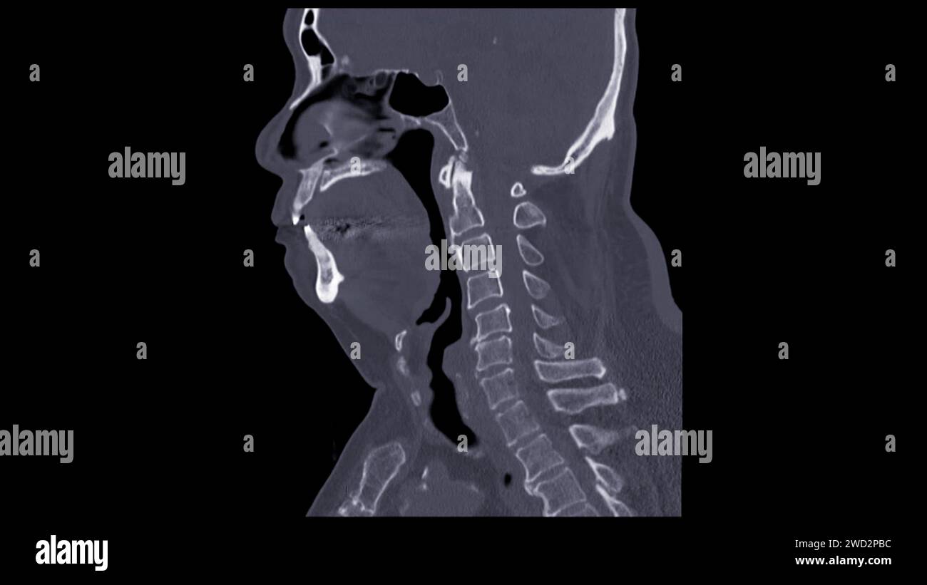 A CT scan of the neck sagittal view for diagnostic technique is ...