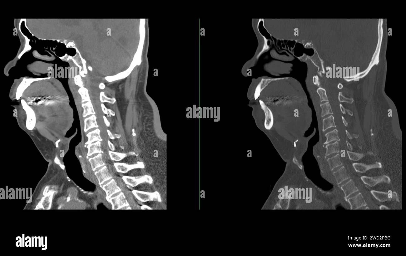 A CT scan of the neck sagittal view for diagnostic technique is ...