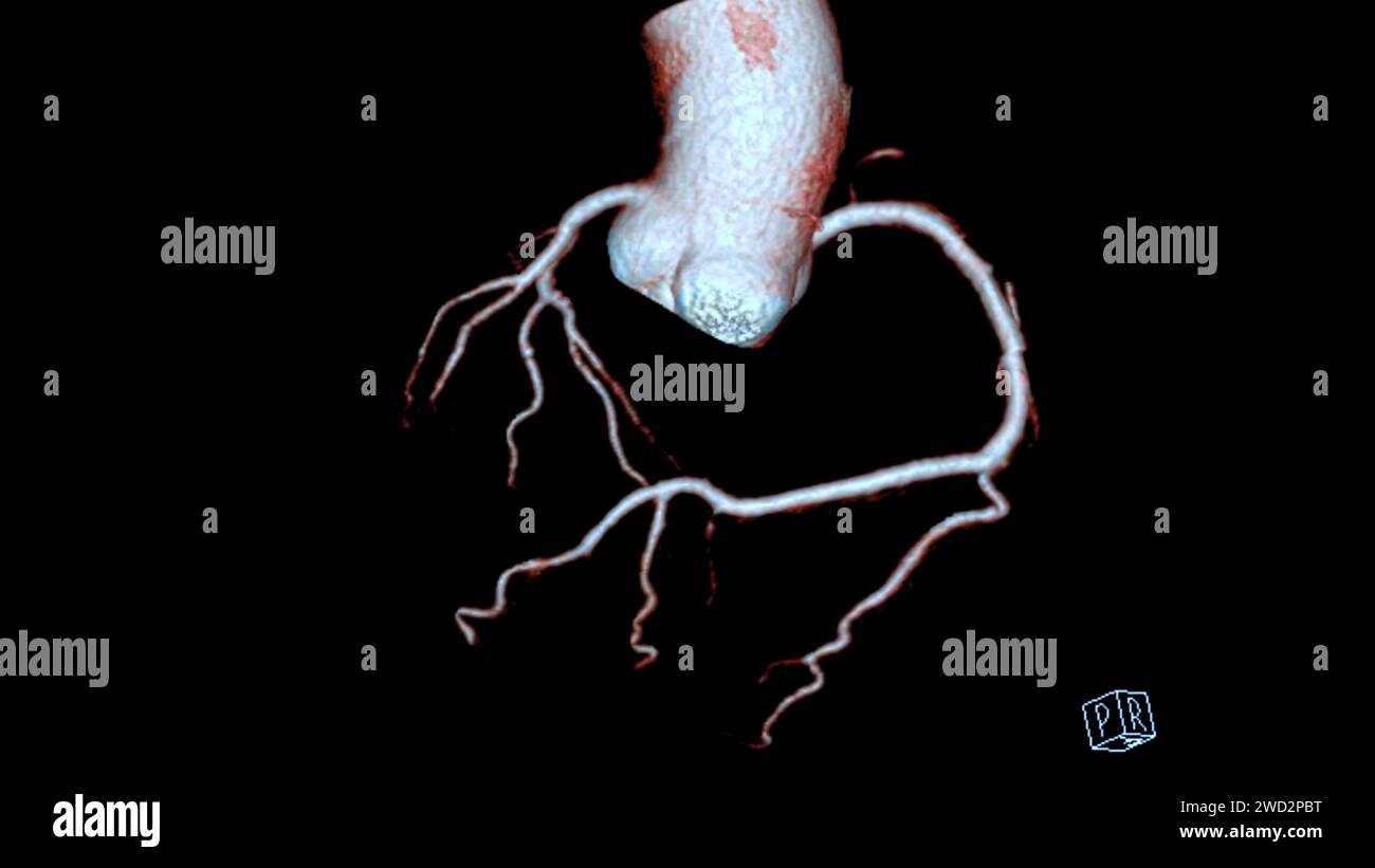 CTA coronary artery 3D rendering is a diagnostic imaging technique ...