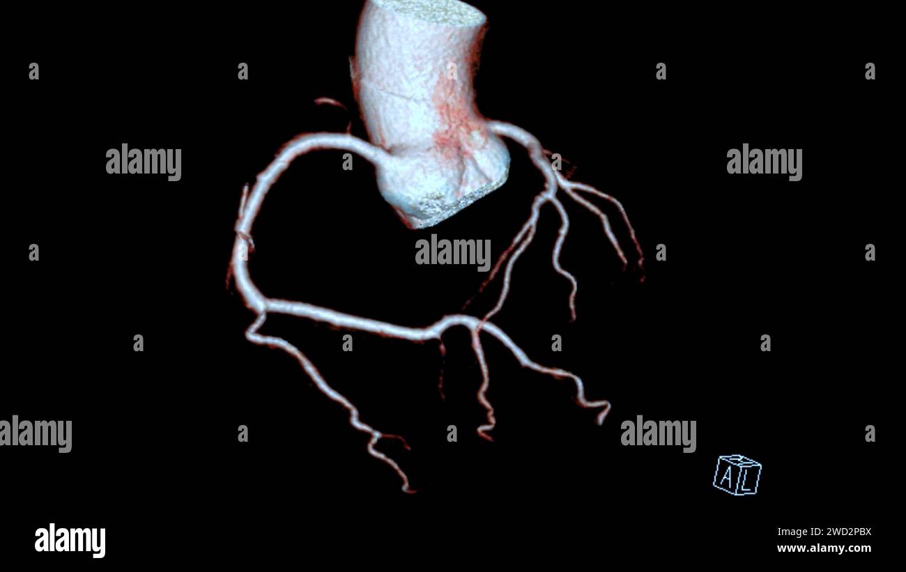 CTA coronary artery 3D rendering is a diagnostic imaging technique ...