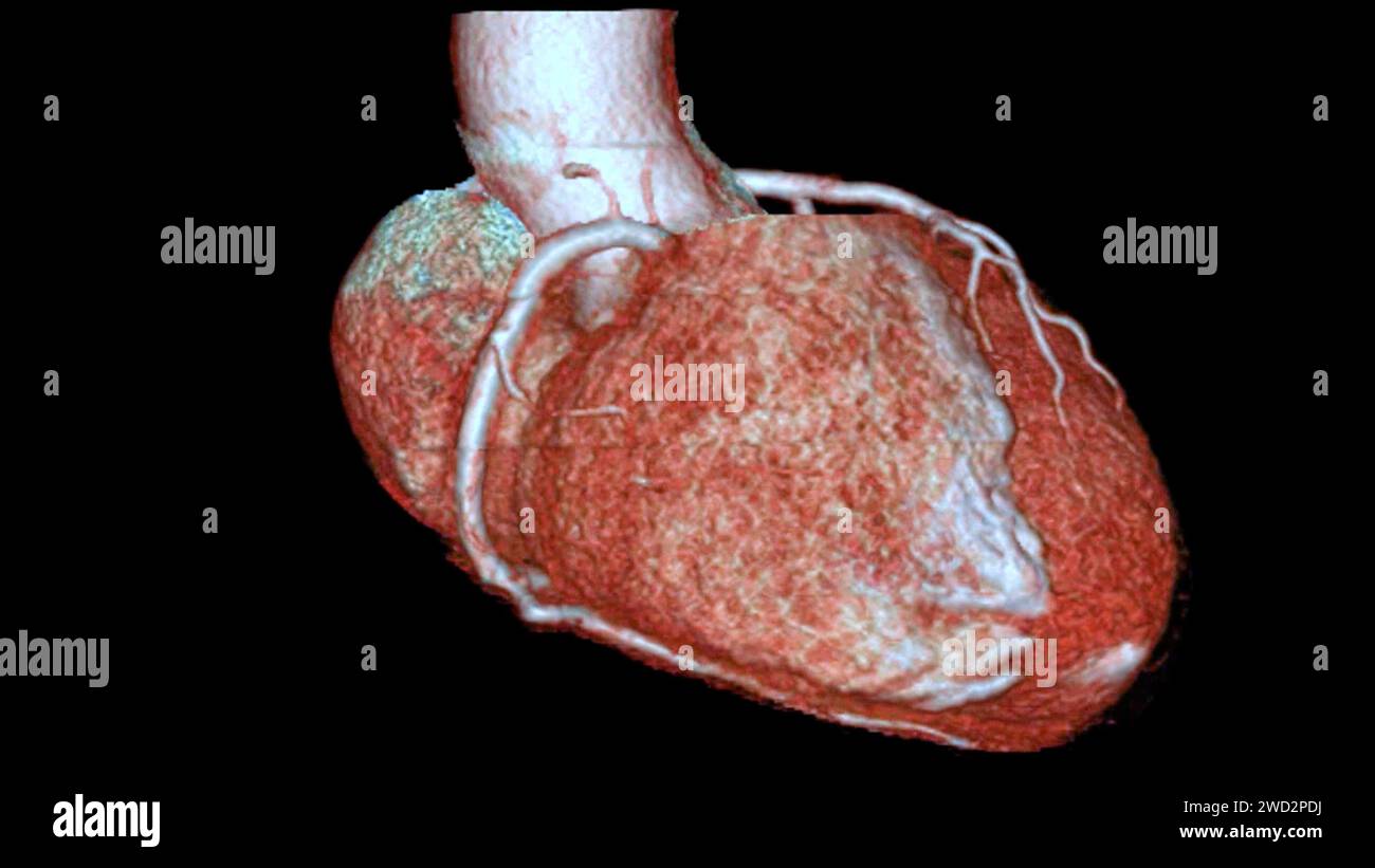 CTA coronary artery 3D rendering is a diagnostic imaging technique ...