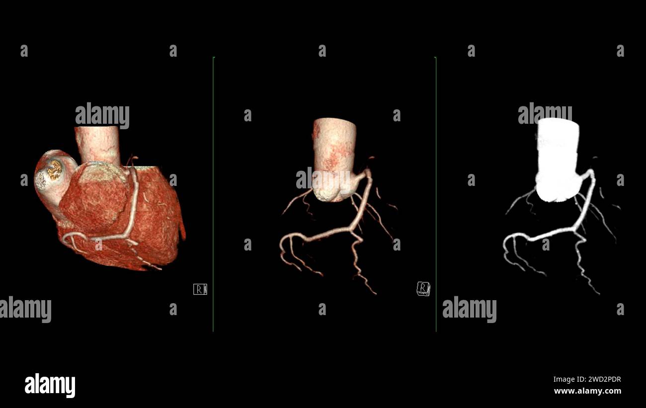 CTA coronary artery 3D rendering is a diagnostic imaging technique ...