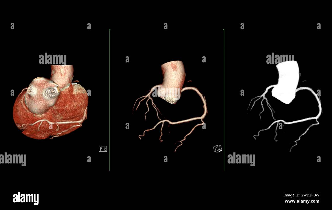 CTA coronary artery 3D rendering is a diagnostic imaging technique ...
