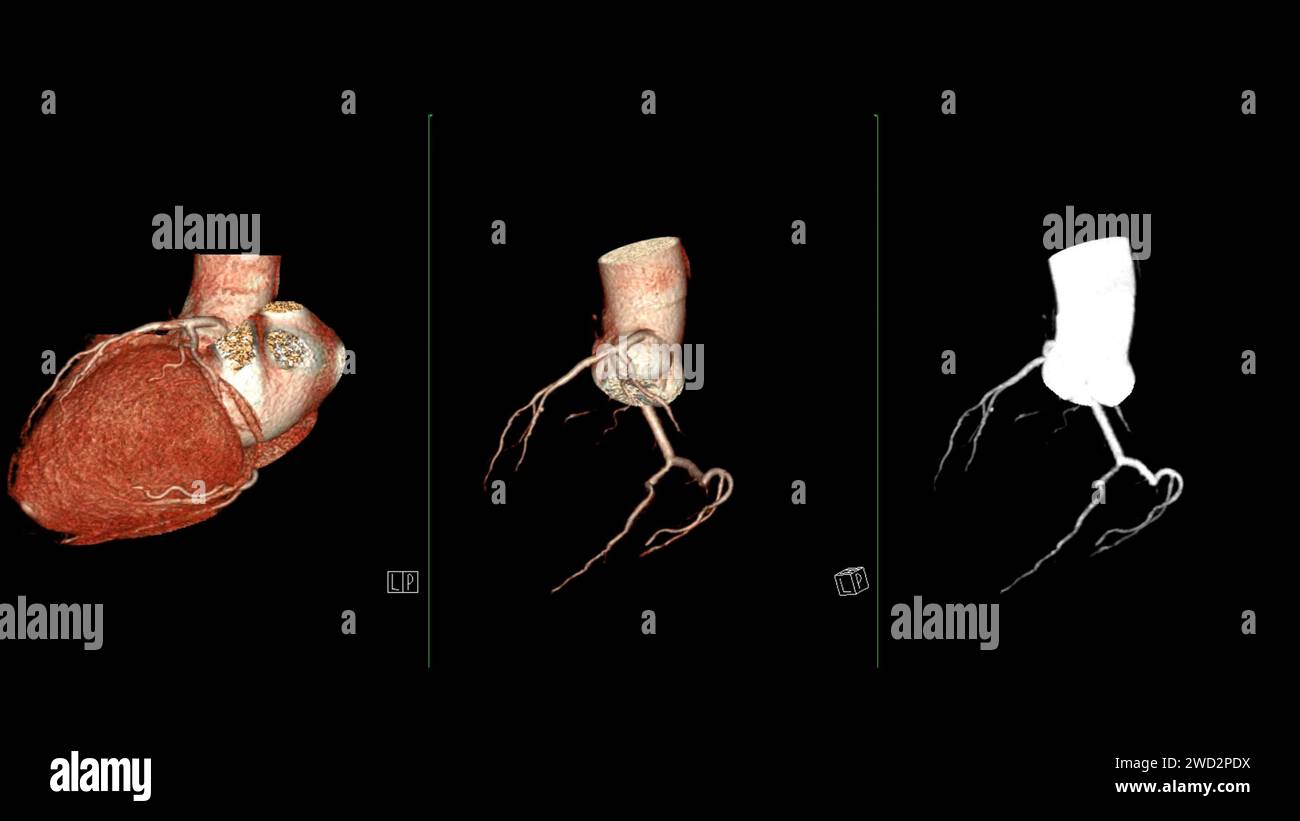CTA coronary artery 3D rendering is a diagnostic imaging technique ...