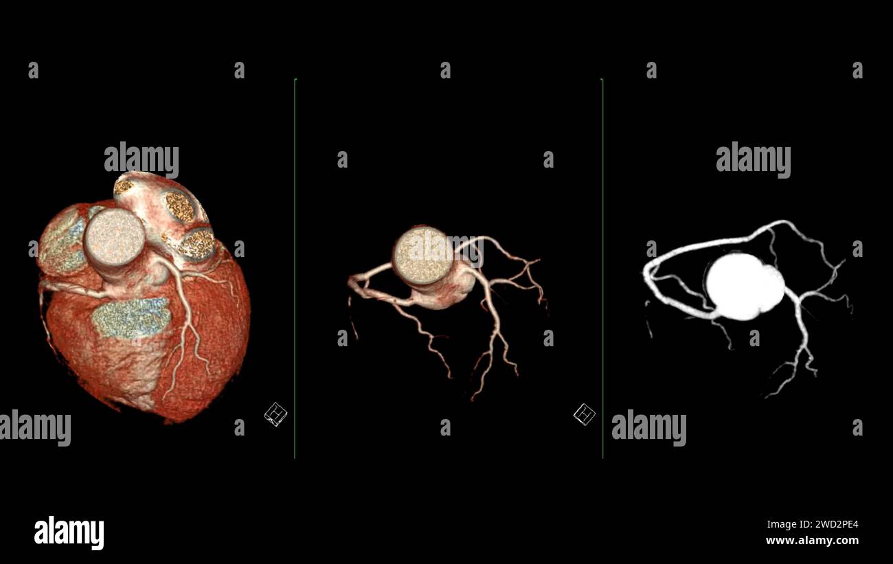 CTA coronary artery 3D rendering is a diagnostic imaging technique ...
