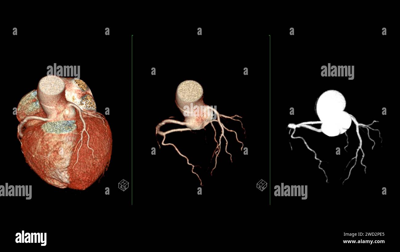 CTA coronary artery 3D rendering is a diagnostic imaging technique ...