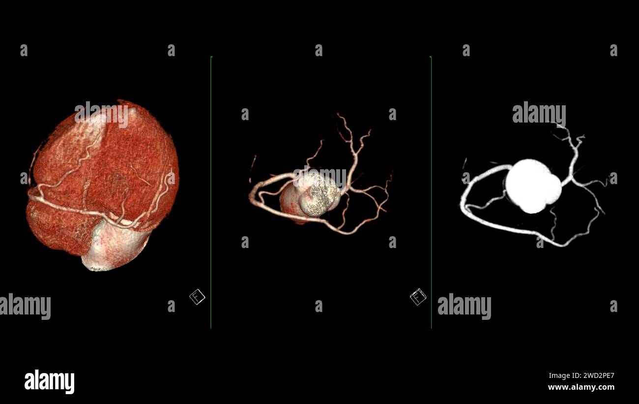 CTA coronary artery 3D rendering is a diagnostic imaging technique ...