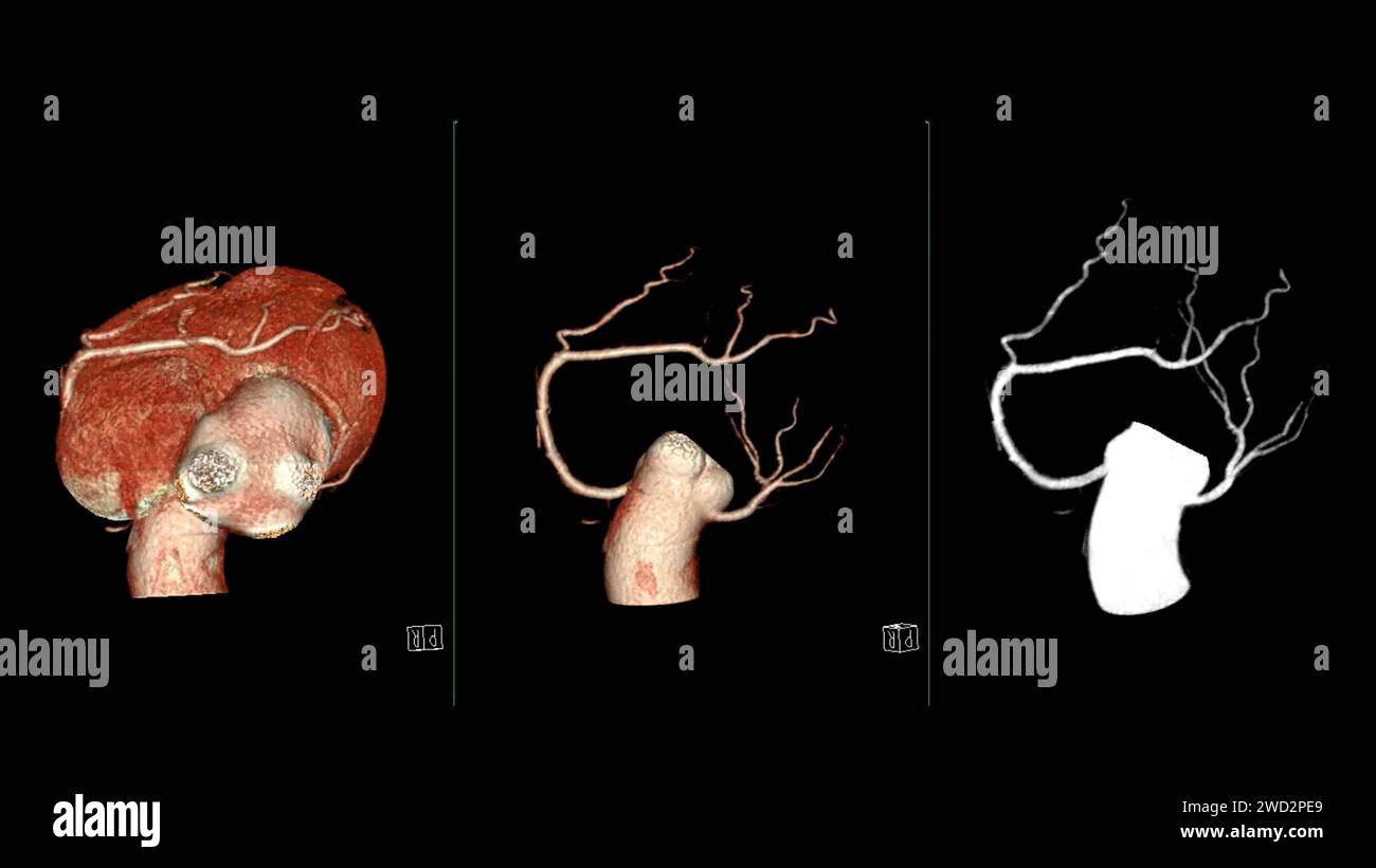 CTA coronary artery 3D rendering is a diagnostic imaging technique ...