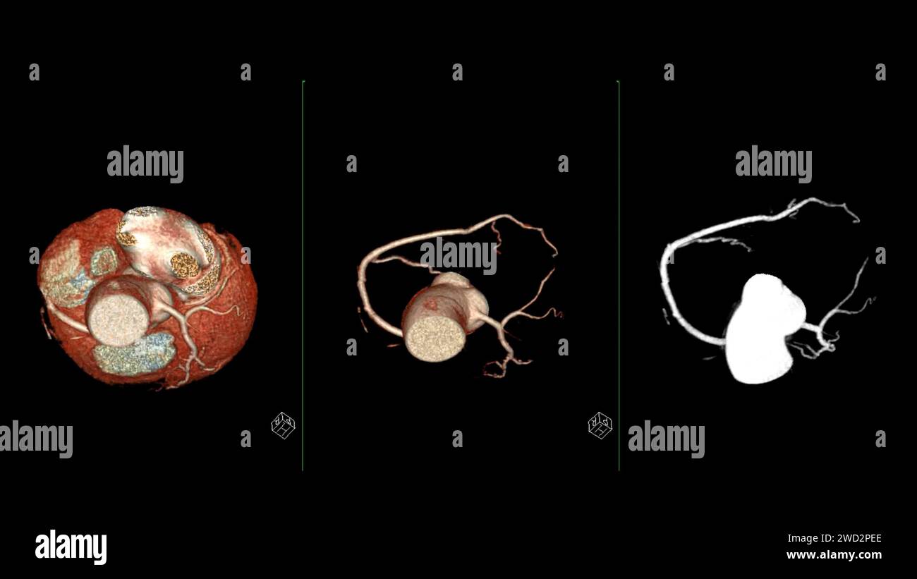 CTA coronary artery 3D rendering is a diagnostic imaging technique ...