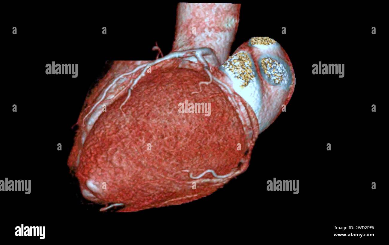 CTA coronary artery 3D rendering is a diagnostic imaging technique ...