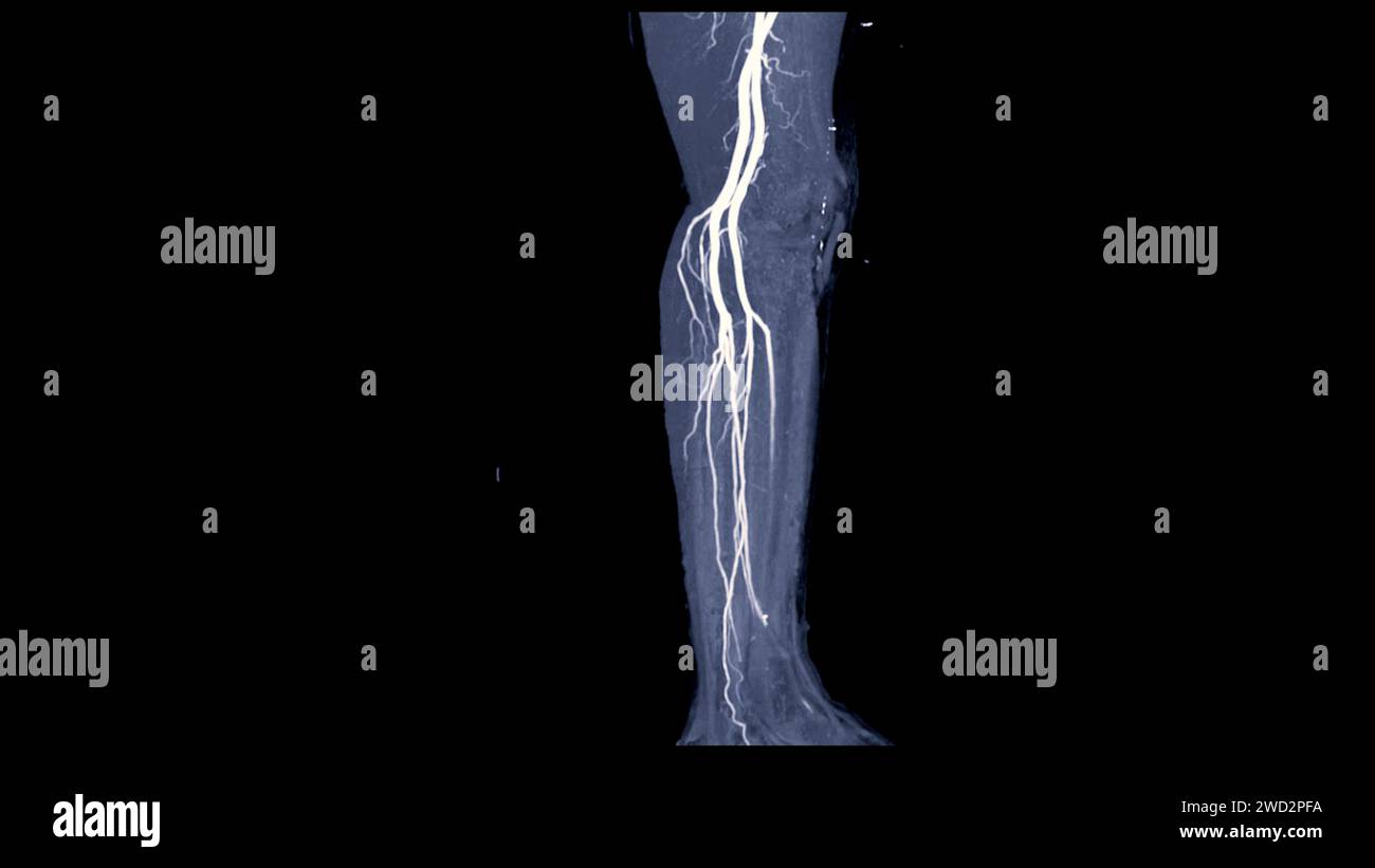 CTA femoral artery run off image of femoral artery for diagnostic Acute ...
