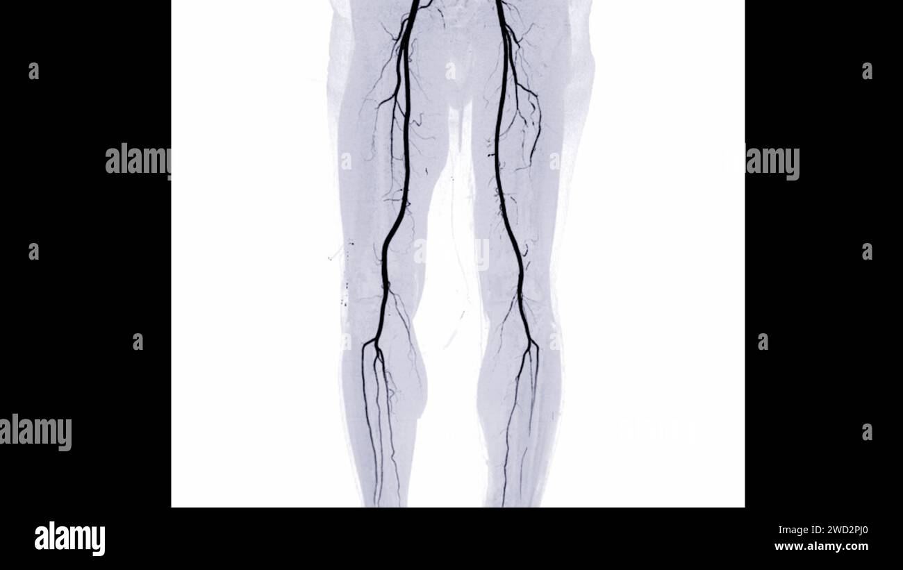 CTA femoral artery run off image of femoral artery for diagnostic Acute ...