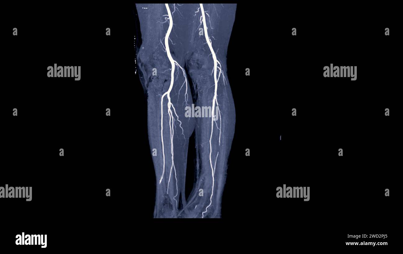 CTA femoral artery run off image of femoral artery for diagnostic Acute ...