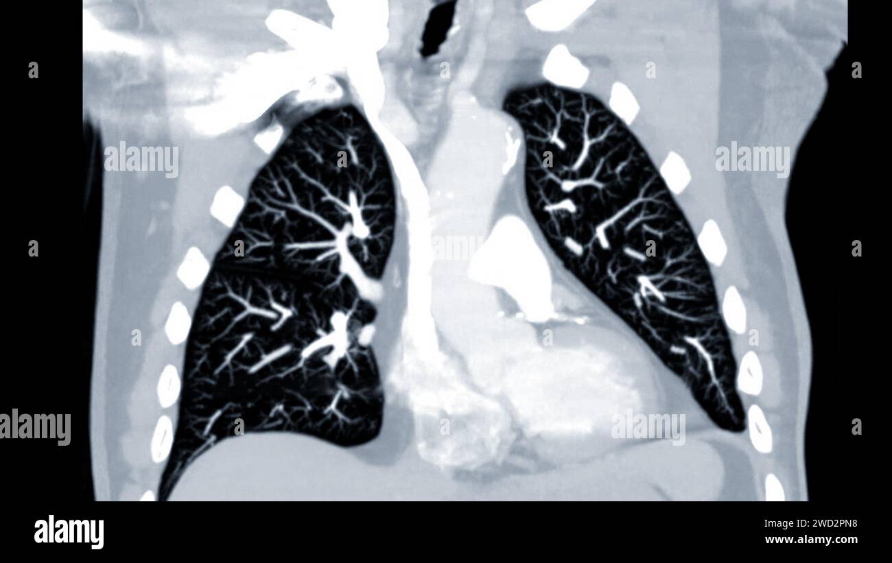 CTPA or CTA pulmonary artery .This imaging technique offers a clear ...