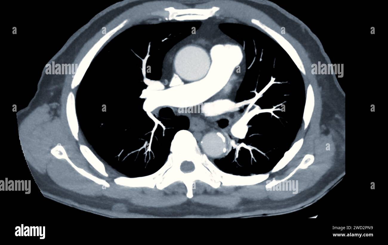 CTPA or CTA pulmonary artery .This imaging technique offers a clear ...