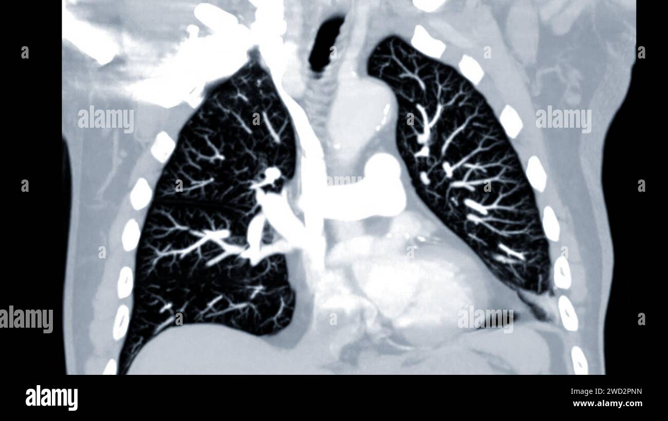 CTPA or CTA pulmonary artery .This imaging technique offers a clear ...