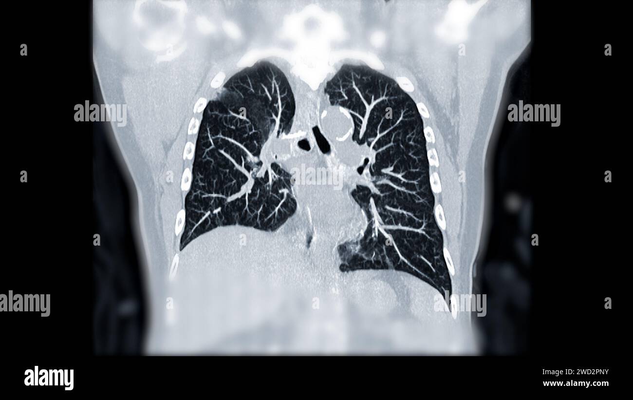 CTPA or CTA pulmonary artery .This imaging technique offers a clear view of the pulmonary ...