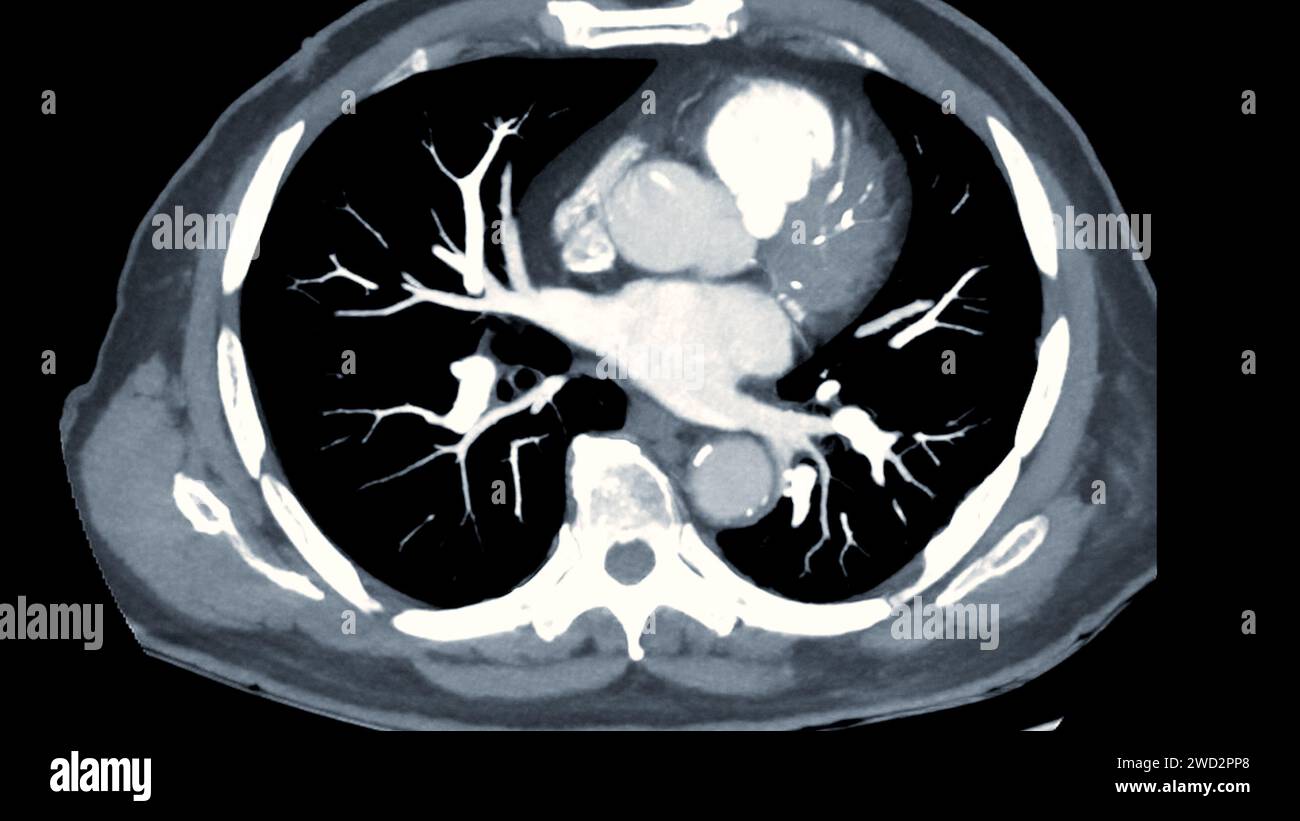CTPA or CTA pulmonary artery .This imaging technique offers a clear ...