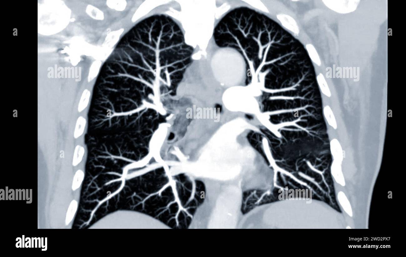 CTPA or CTA pulmonary artery .This imaging technique offers a clear ...