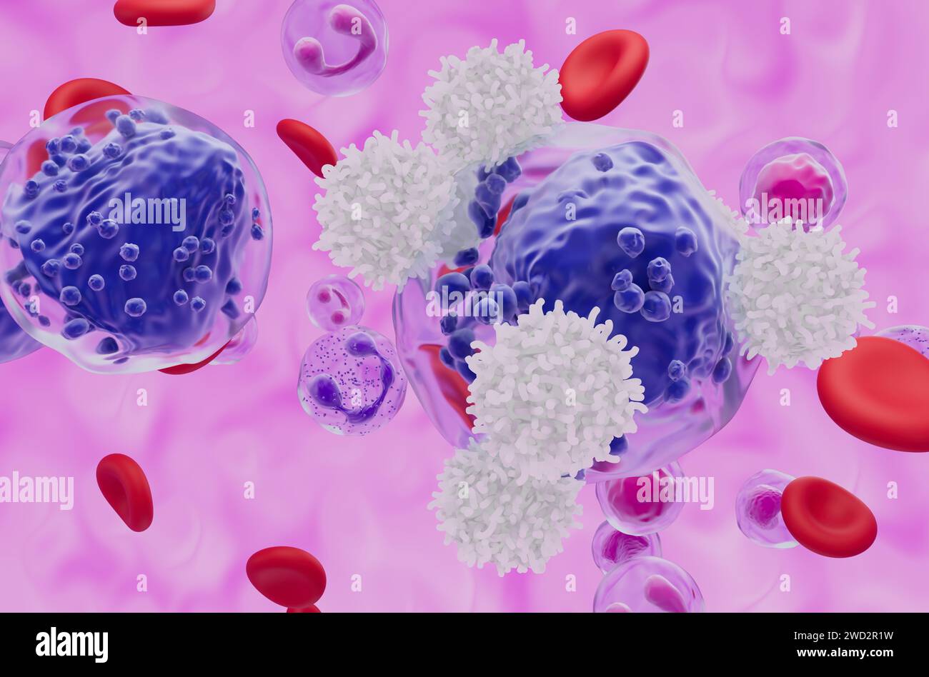 White blood cells with Acute myeloid leukaemia (AML) cells - closeup ...