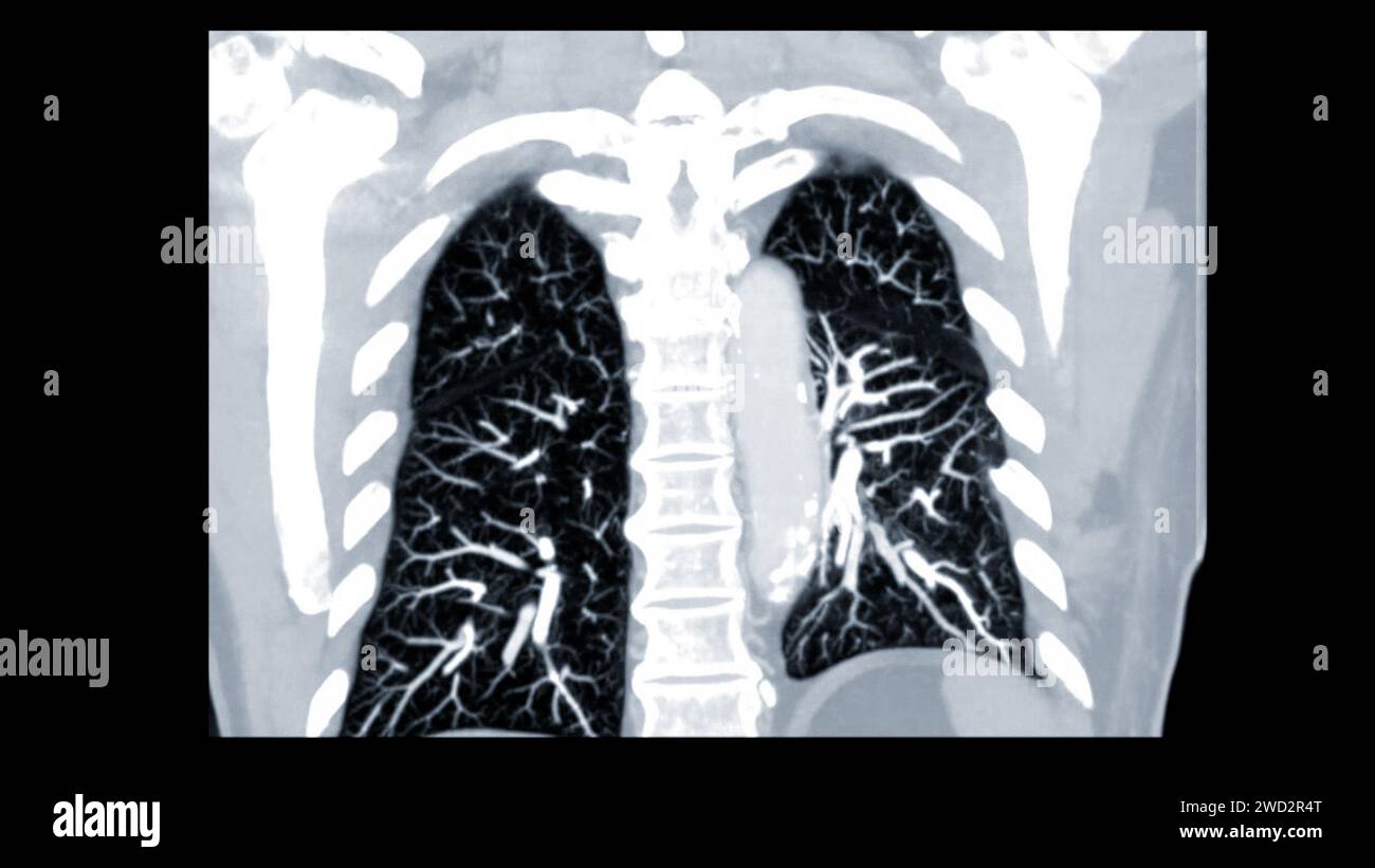 CTPA or CTA pulmonary artery .This imaging technique offers a clear ...