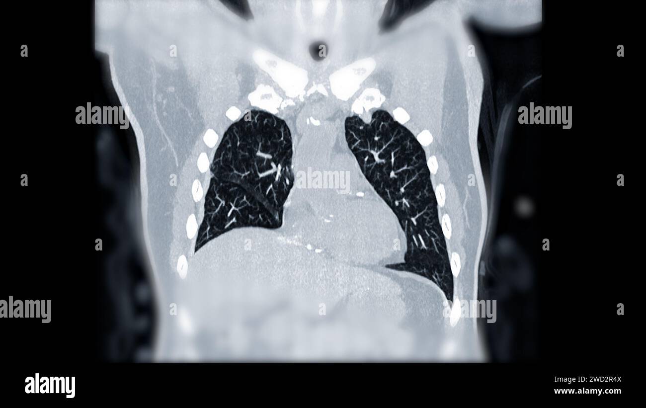 CTPA or CTA pulmonary artery .This imaging technique offers a clear ...