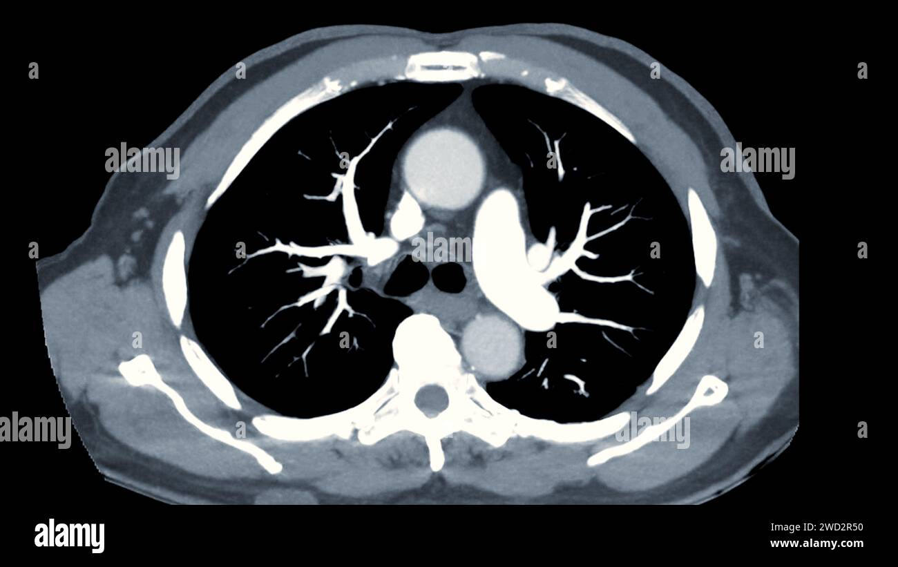 CTPA or CTA pulmonary artery .This imaging technique offers a clear view of the pulmonary ...