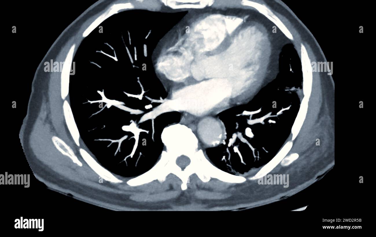 CTPA or CTA pulmonary artery .This imaging technique offers a clear ...