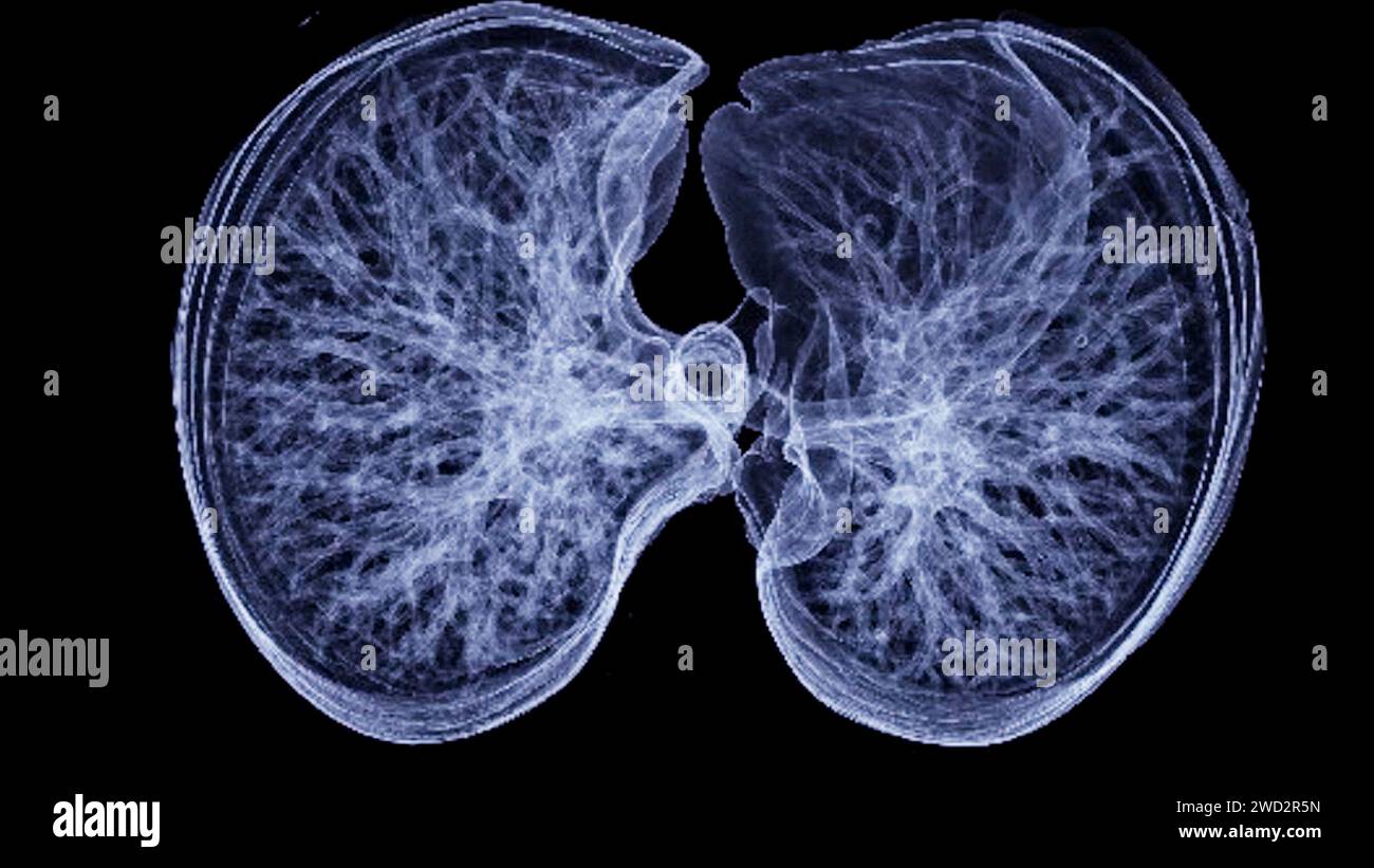 CT Chest or Lung 3d rendering image showing Trachea and lung in ...