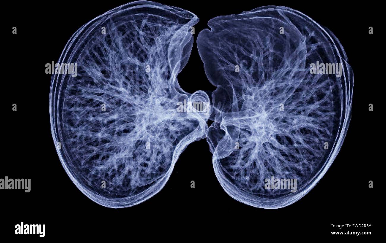 CT Chest or Lung 3d rendering image showing Trachea and lung in ...