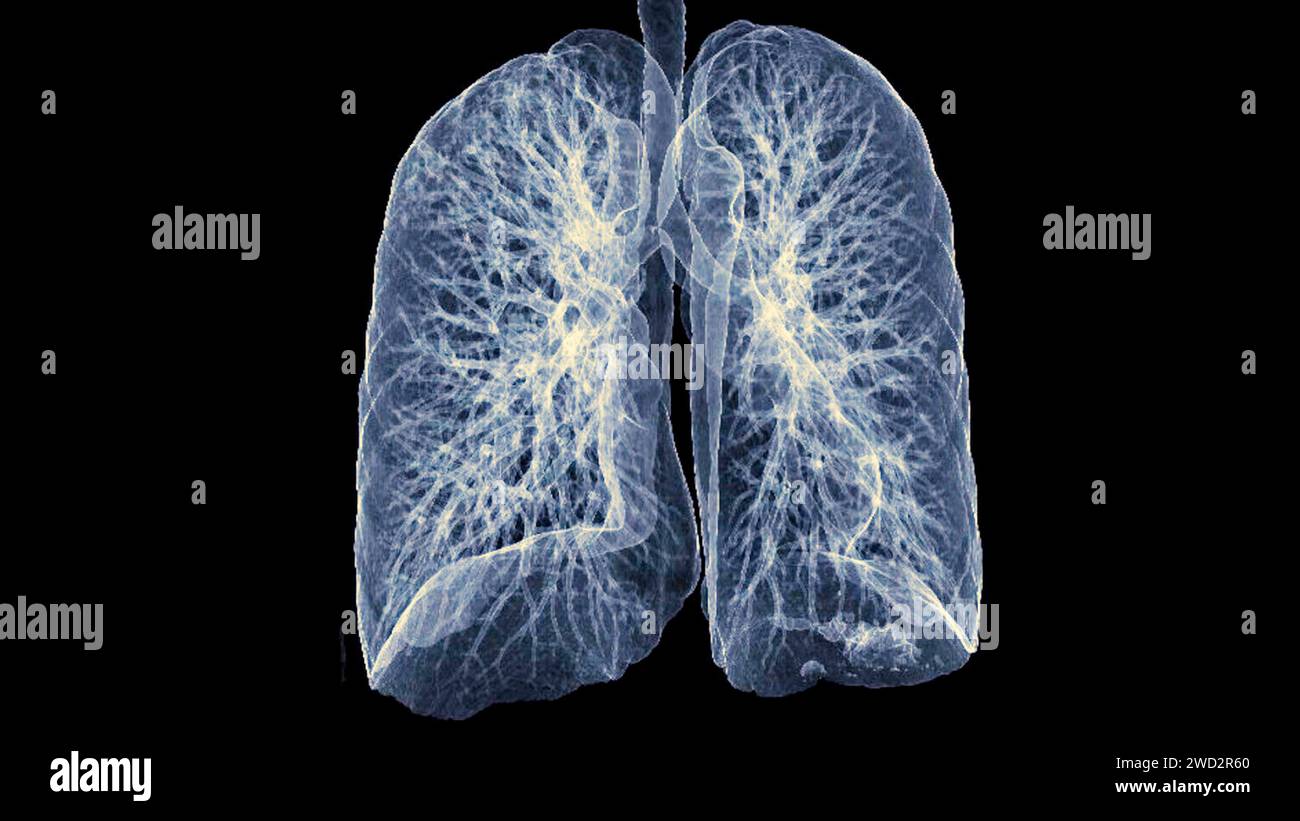 CT Chest or Lung 3d rendering image showing Trachea and lung in ...