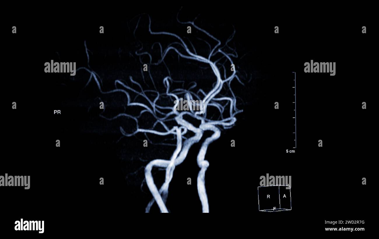 MRA Brain , This imaging technique provides clear visuals of the brain ...