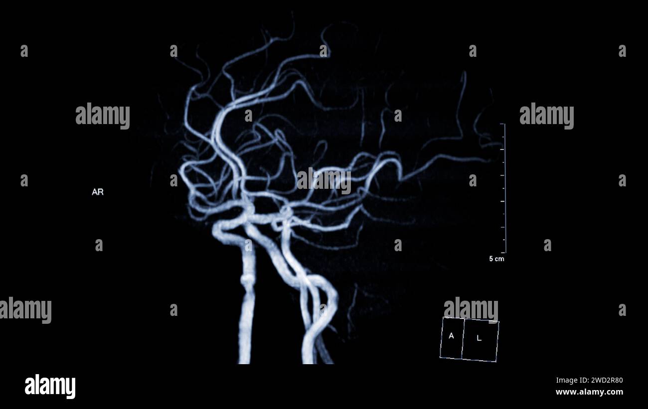 MRA Brain , This imaging technique provides clear visuals of the brain ...