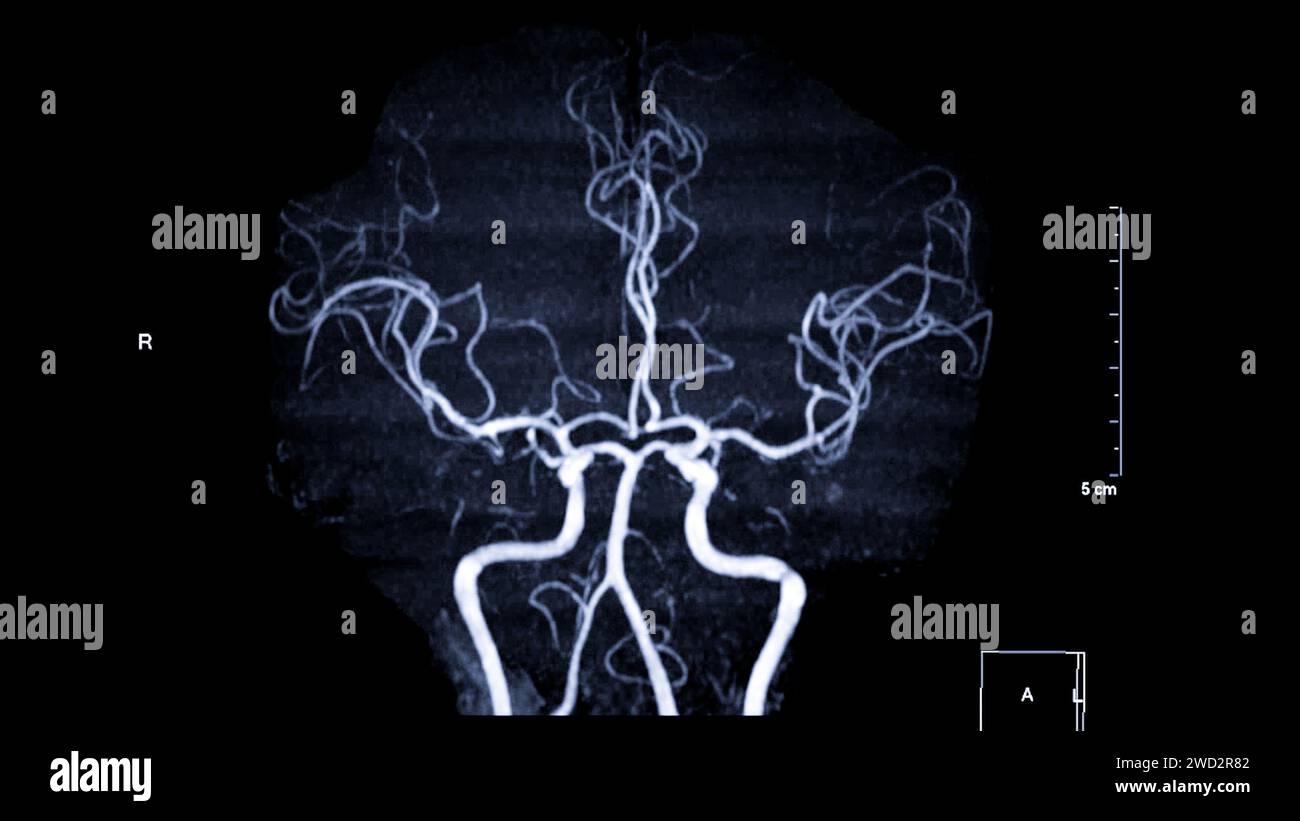 MRA Brain , This imaging technique provides clear visuals of the brain ...
