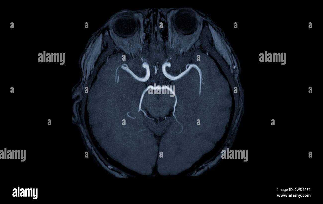 MRA Brain axial view , This imaging technique provides clear visuals of ...