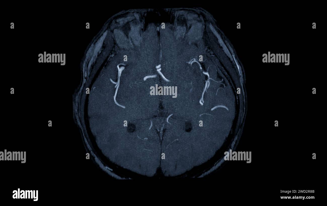 MRA Brain axial view , This imaging technique provides clear visuals of ...