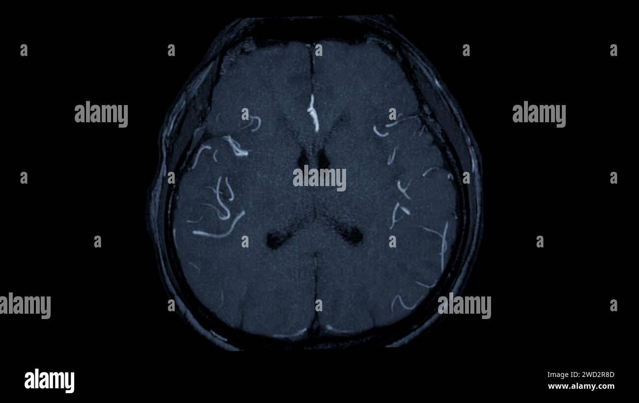 MRA Brain axial view , This imaging technique provides clear visuals of ...