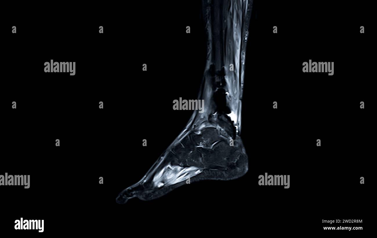 MRI FOOT scan Sagittal view T2 Fat suppression technique for diagnostic ...