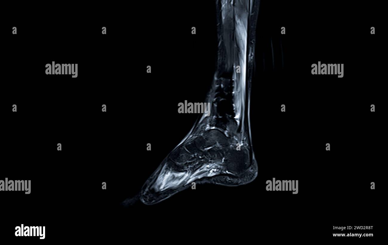 MRI FOOT scan Sagittal view T2 Fat suppression technique for diagnostic ...