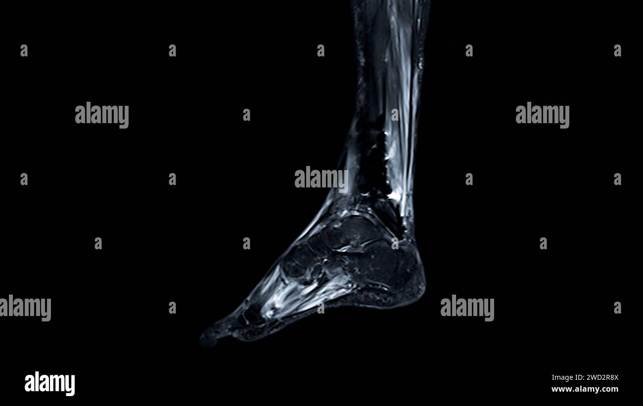 MRI FOOT scan Sagittal view T2 Fat suppression technique for diagnostic ...
