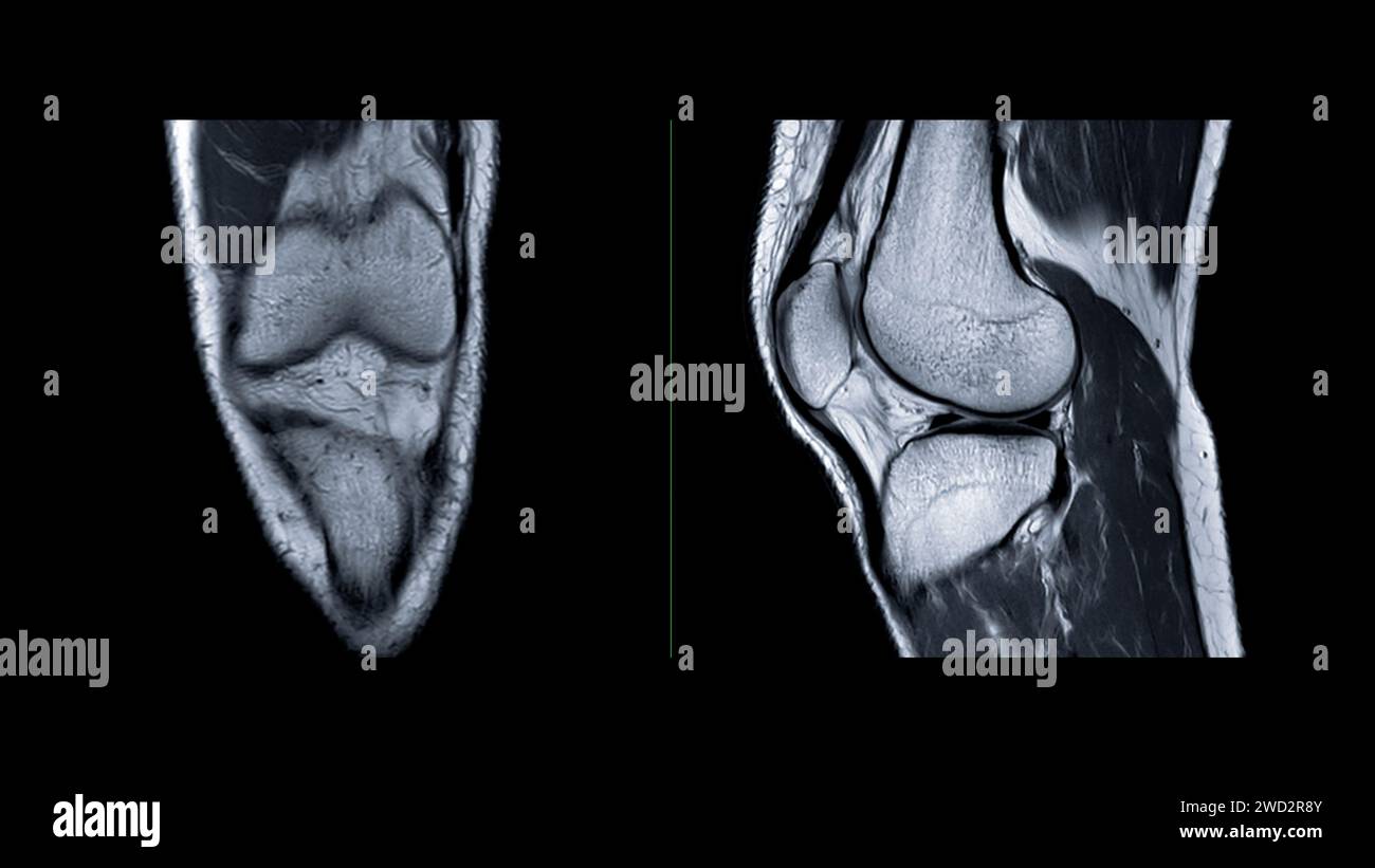 Magnetic resonance imaging or MRI of knee joint. This diagnostic ...