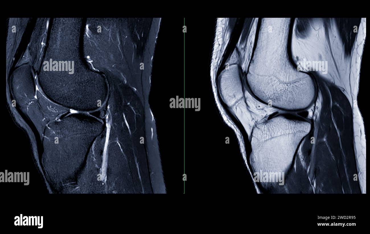 Magnetic resonance imaging or MRI of knee joint. This diagnostic ...