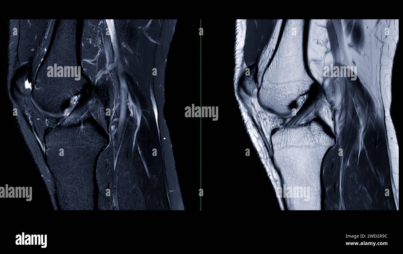 Magnetic resonance imaging or MRI of knee joint. This diagnostic ...