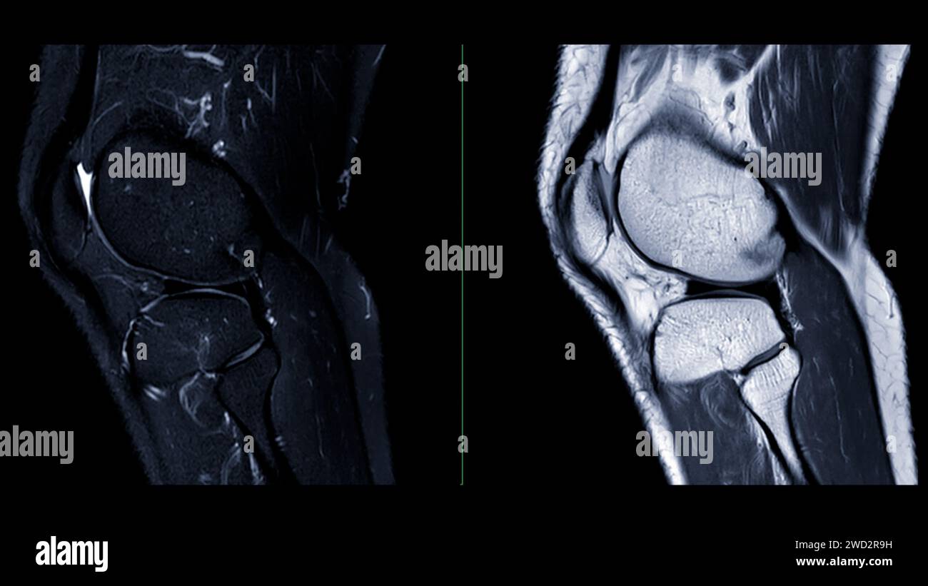 Magnetic resonance imaging or MRI of knee joint. This diagnostic ...