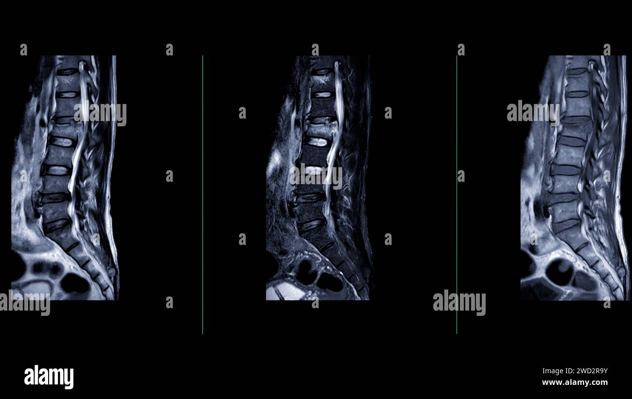 MRI L-S spine or lumbar spine Sagittal view for diagnosis spinal cord ...