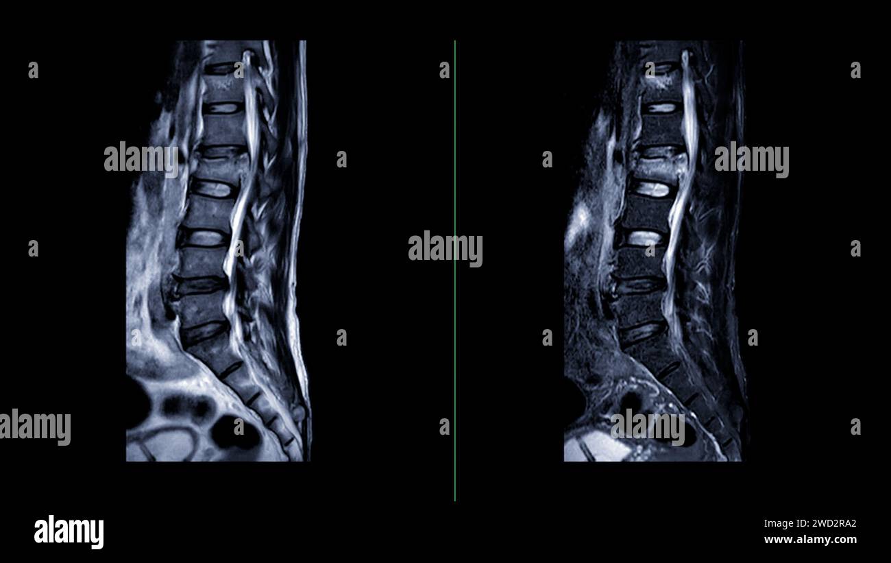 MRI L-S spine or lumbar spine Sagittal view for diagnosis spinal cord ...